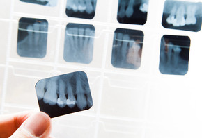 Rontgen Periapical Dental Digital 1x di South Dental | HDmall