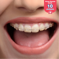 Pemasangan Behel Sapphire oleh drg. Spesialis Ortodontis di Klinik ...