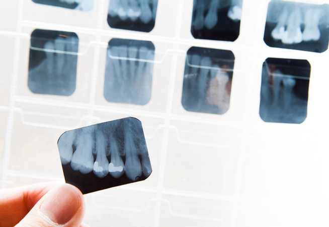 Rontgen Periapikal Dental Digital di South Dental | HDmall