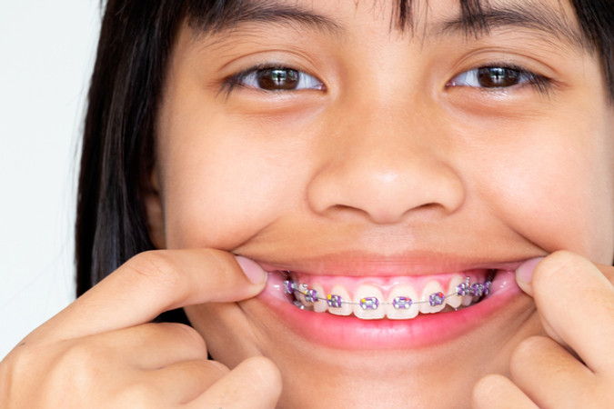 😁 Diskon Pemasangan Behel Sapphire Hingga 40%. Harga mulai dari Rp ...