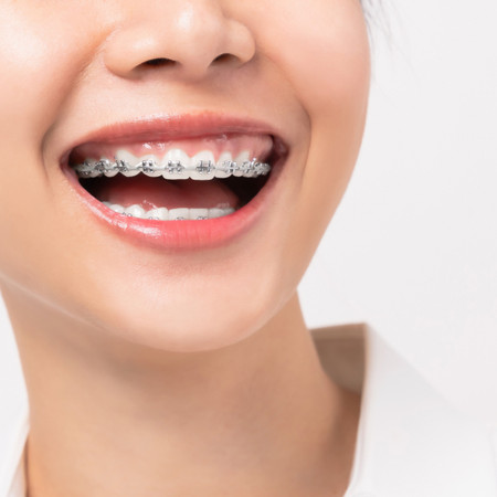 Pasang Behel Sapphire Konvensional di DDC Caman | HDmall