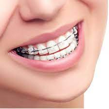 Pasang Behel Sapphire oleh drg. Umum di Smile Up Dental Clinic | HDmall