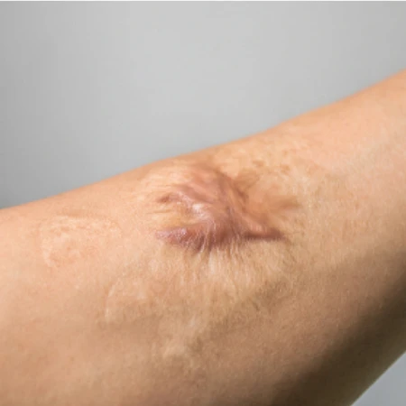 Injeksi Keloid di Dayu The Skin & Dental Clinic | HDmall