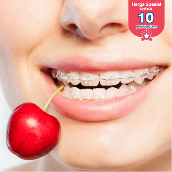 Pasang Behel Sapphire oleh drg. Umum di My Dental Studio | HDmall