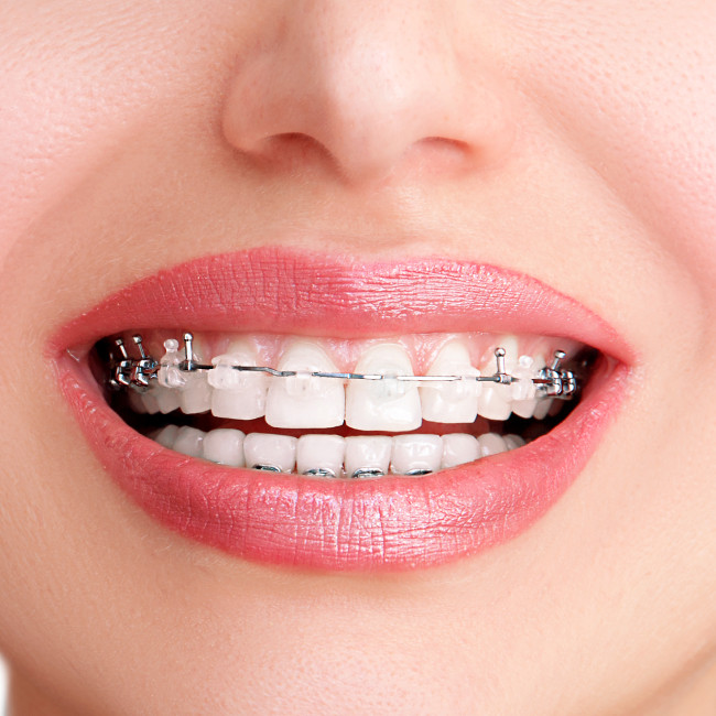 Pasang Behel Sapphire Buatan USA oleh drg. Spesialis Ortodontik di ...