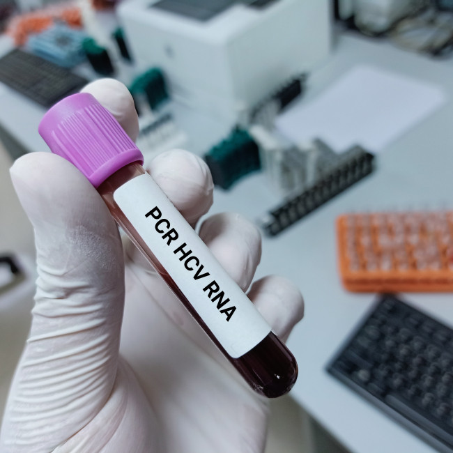 Pemeriksaan Hati (HCV RNA Kuantitatif Swab PCR) di Amalia Medical ...