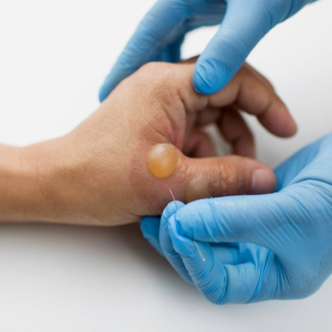 Insisi Abses Besar di FastMed | HDmall