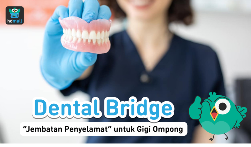 Bridge Gigi Adalah Solusi Gigi Ompong, Ini Kelebihannya | HDmall