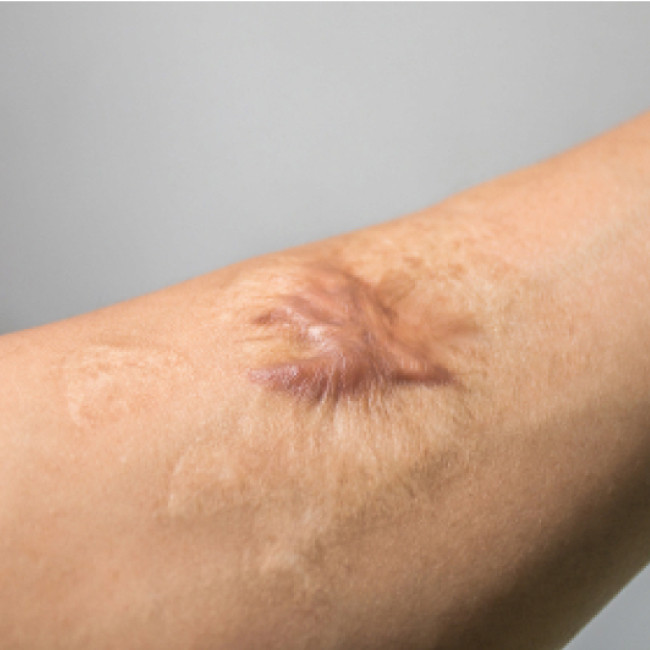 Injeksi Keloid di Dayu The Skin & Dental Clinic | HDmall