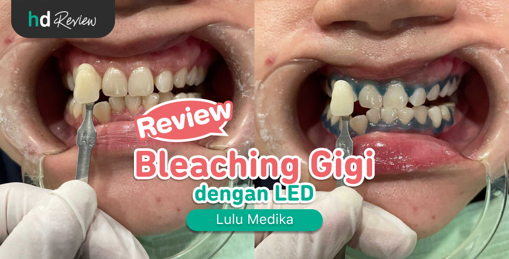 Review Bleaching Gigi di Lulu Medika | HDmall