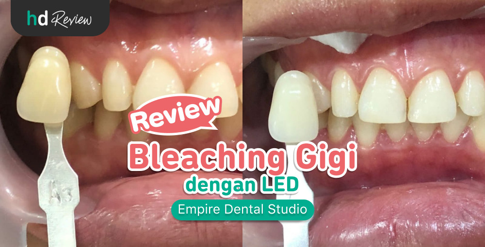 Review Bleaching Gigi di Empire Dental Studio | HDmall