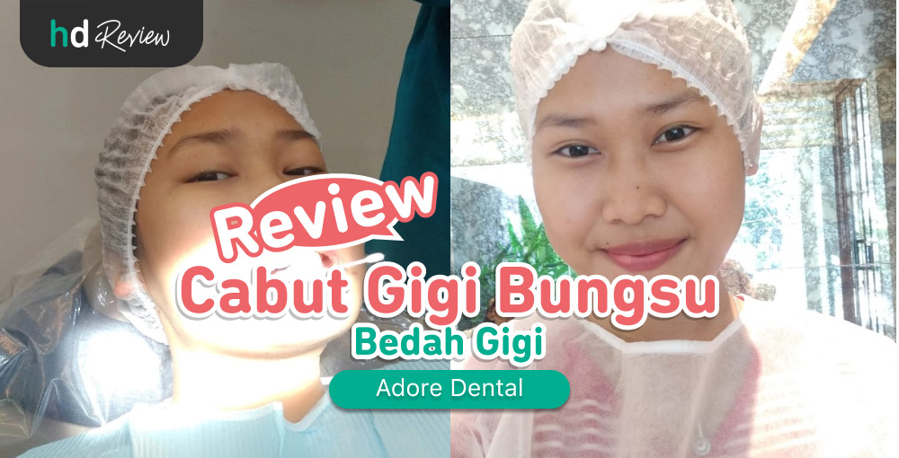 Review Cabut Gigi Bungsu di Adore Dental | HDmall