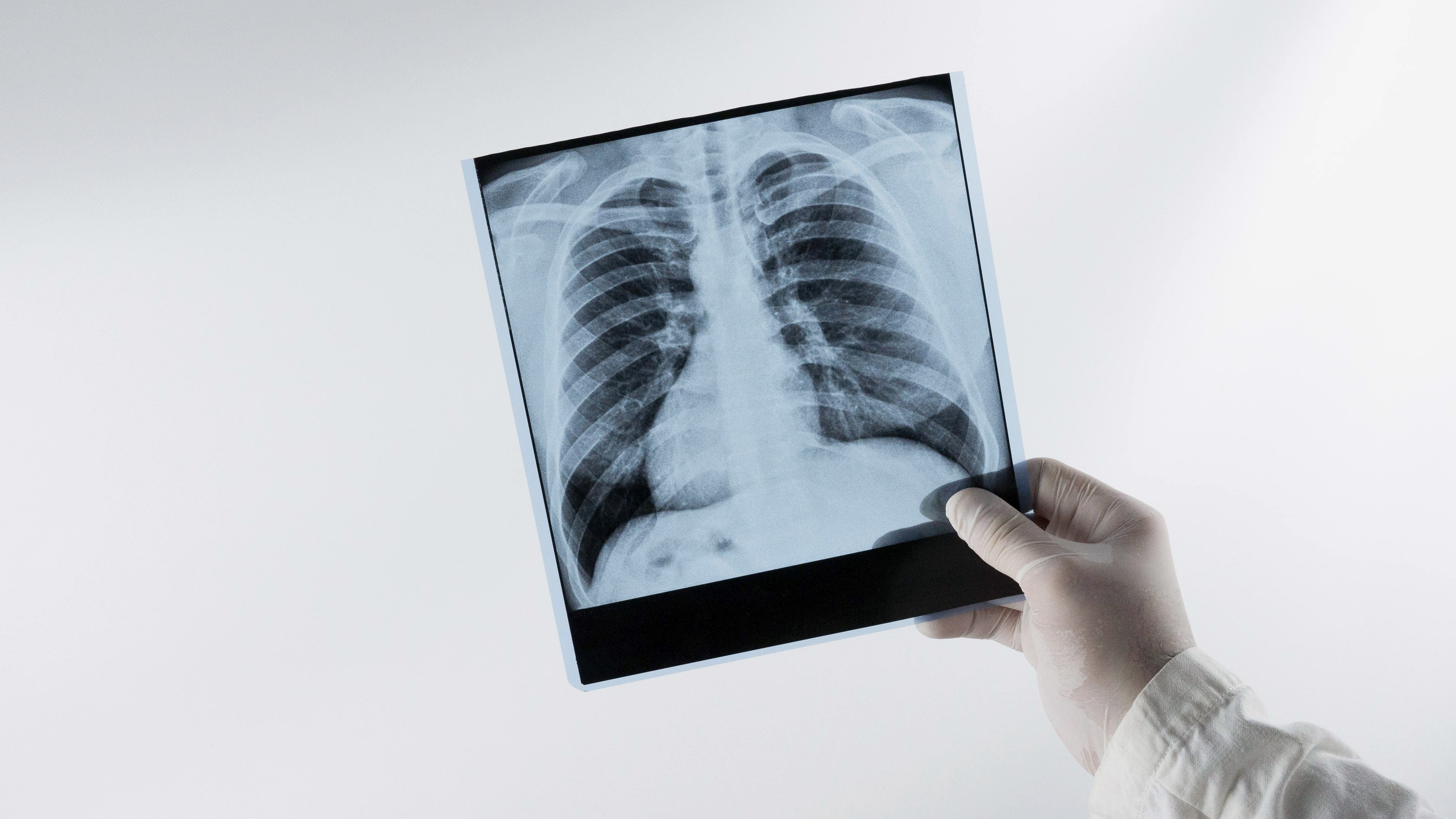 Rontgen Thorax CR untuk Daerah Papua di Laboratorium Prodia | HDmall