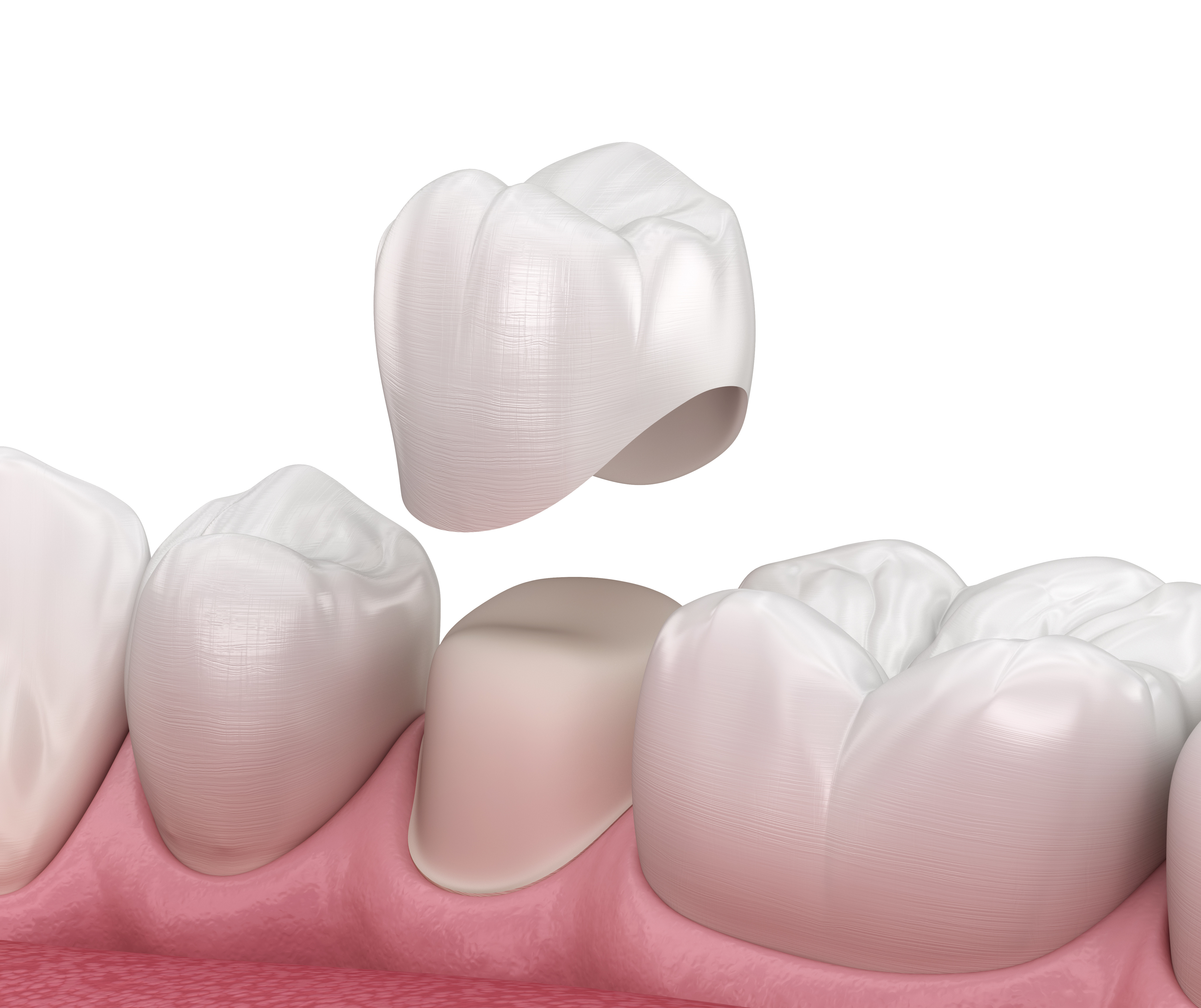 Crown Zirconia Overlay Porcelain (MATERIAL ASIA) di CS Dental | HDmall