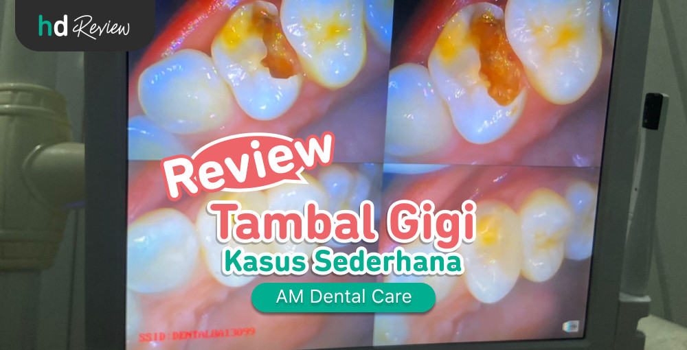 Review Tambal Gigi di AM Dental Care | HDmall