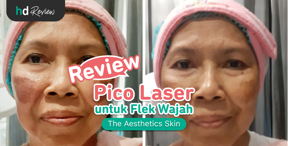 Review Pico Laser di The Aesthetics Skin | HDmall