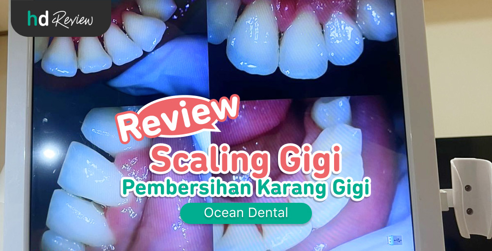 Review Scaling Gigi di Ocean Dental | HDmall