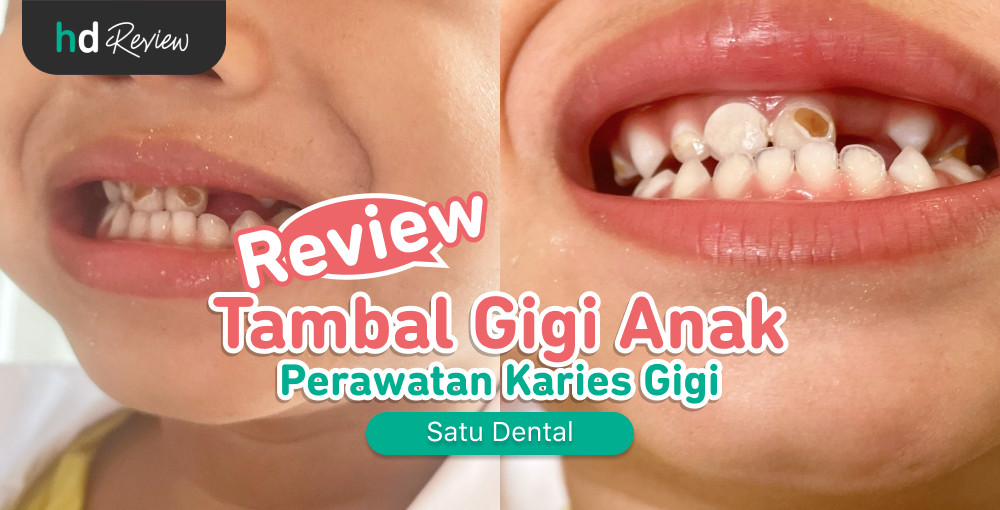 Review Tambal Gigi Anak di Satu Dental | HDmall