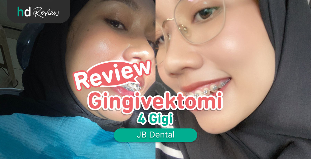 Review Gingivektomi di JB Dental Clinic | HDmall