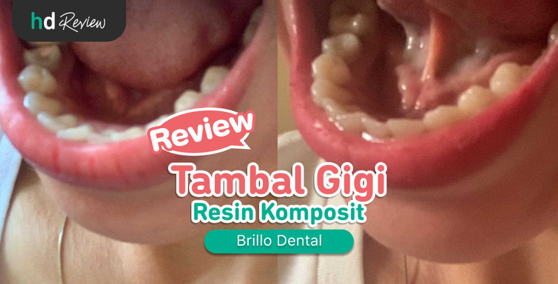 Review Tambal Gigi di Brillo Dental Care | HDmall