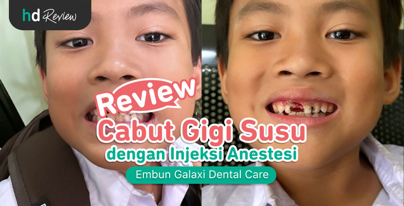 Review Cabut Gigi Susu di Embun Galaxi Dental Care | HDmall